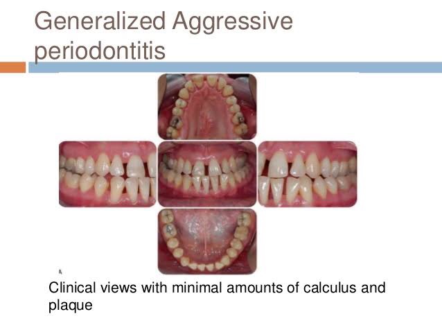 GENERALIZED AGGRESSIVE PERIODONTITIS – Dentowesome
