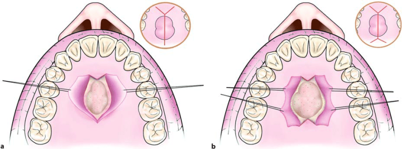 Surgical Incisions and Flaps – Dentowesome
