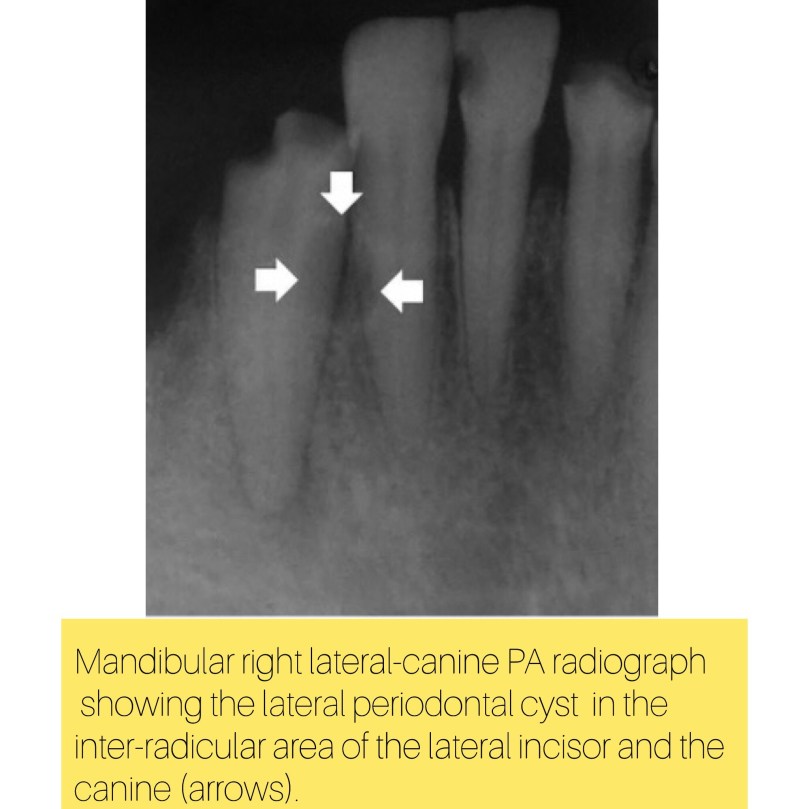 Differential Diagnosis of Periapical Radiolucencies – Dentowesome