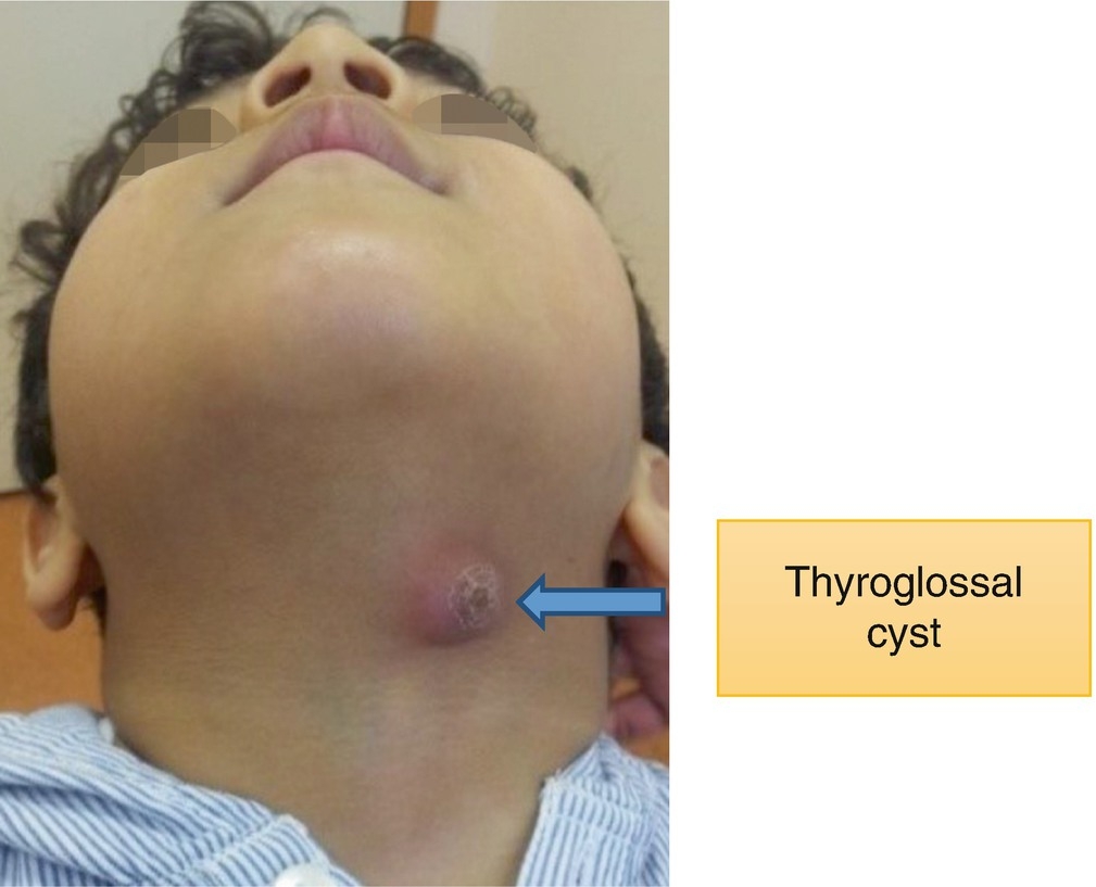 thyroglossal cyst – Dentowesome