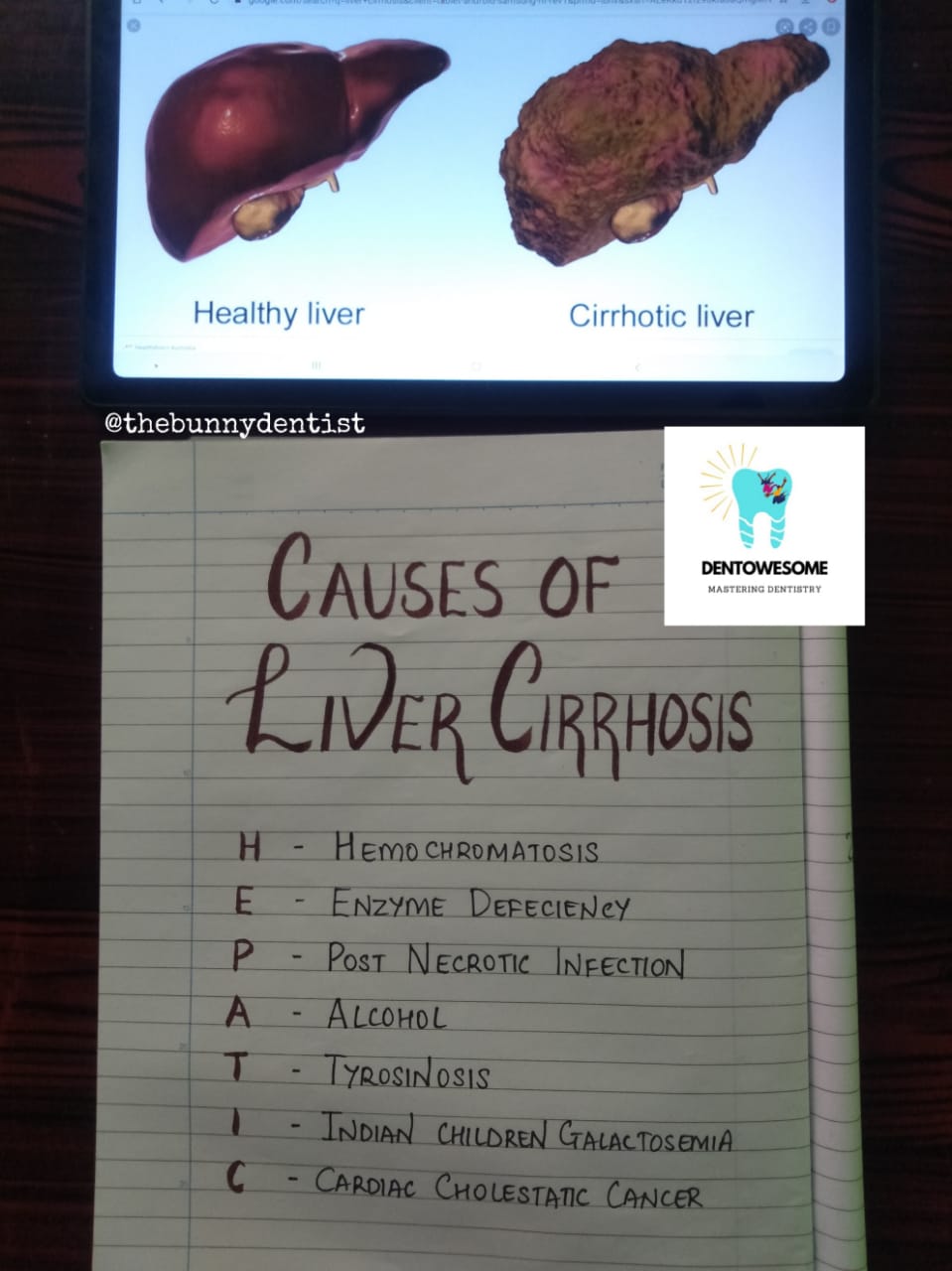 Mnemonic on Causes of Liver Cirrhosis – Dentowesome
