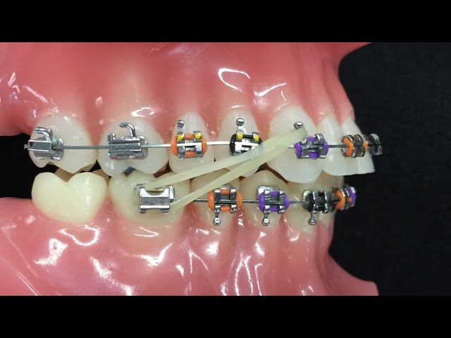 Exploring the Impact of Class II Elastics on the Functional Occlusal ...