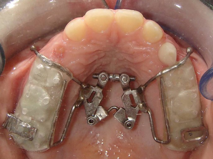 Alt-RAMEC Explained: Maxillary Expansion Technique – Dentowesome