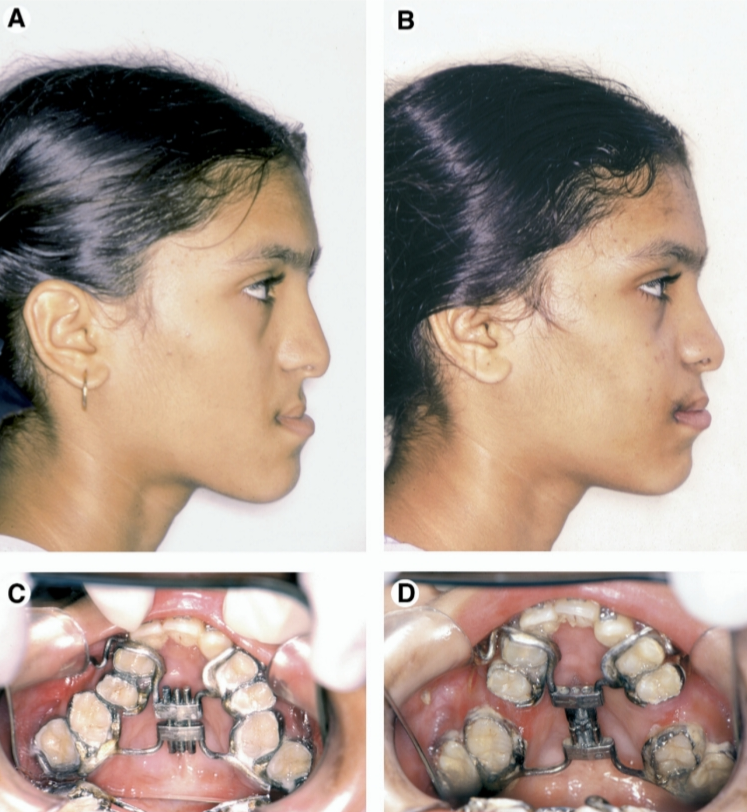 Anterior Maxillary Distraction by Tooth-Borne Palatal Distractor ...