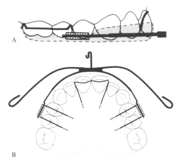 The treatment of severe ‘gummy’ Class II division 1 malocclusion using ...