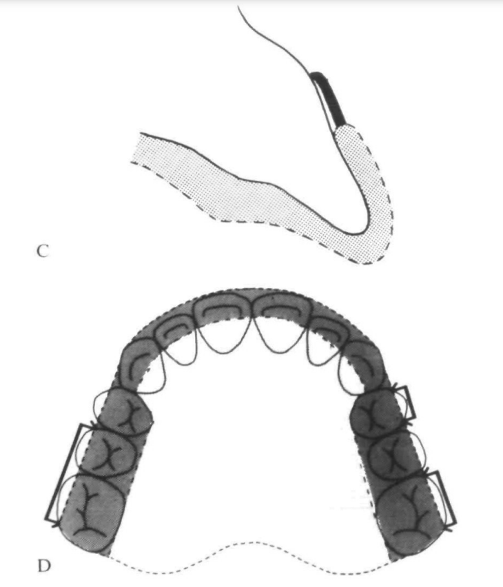 The treatment of severe ‘gummy’ Class II division 1 malocclusion using ...