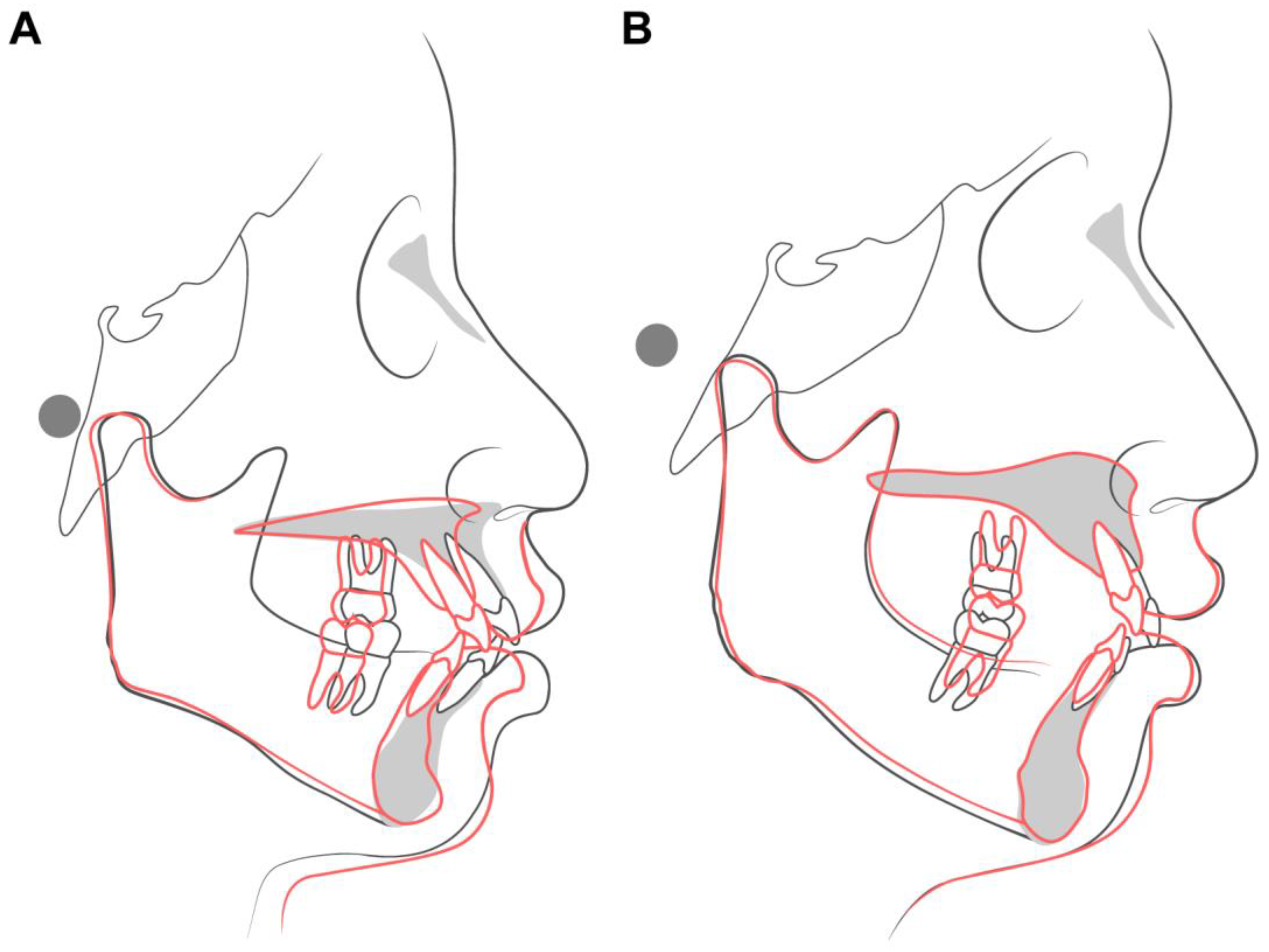 Determinants of Successful Treatment of Bimaxillary Protrusion ...