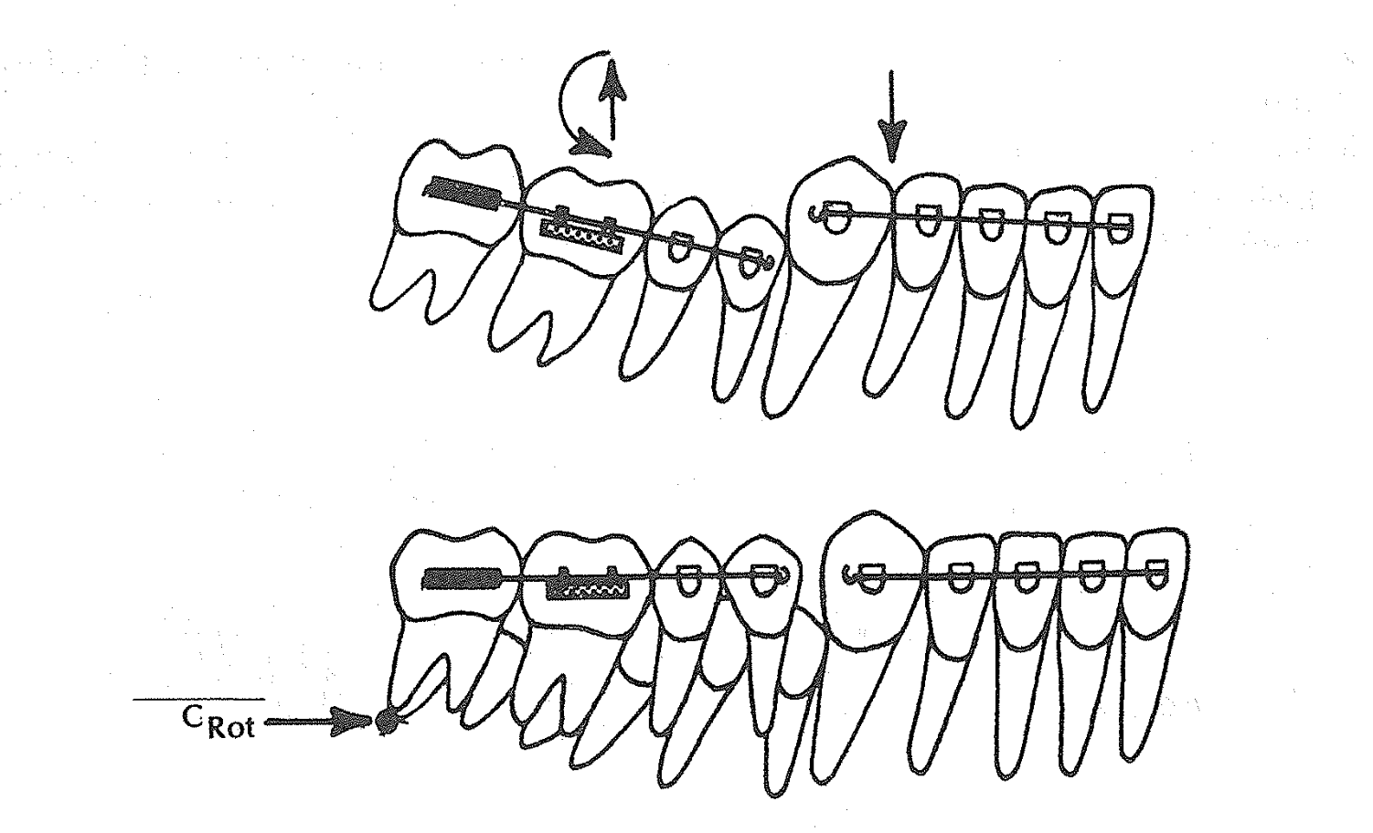 Tip-Back Mechanism: Biomechanics of Deep Bite – Dentowesome