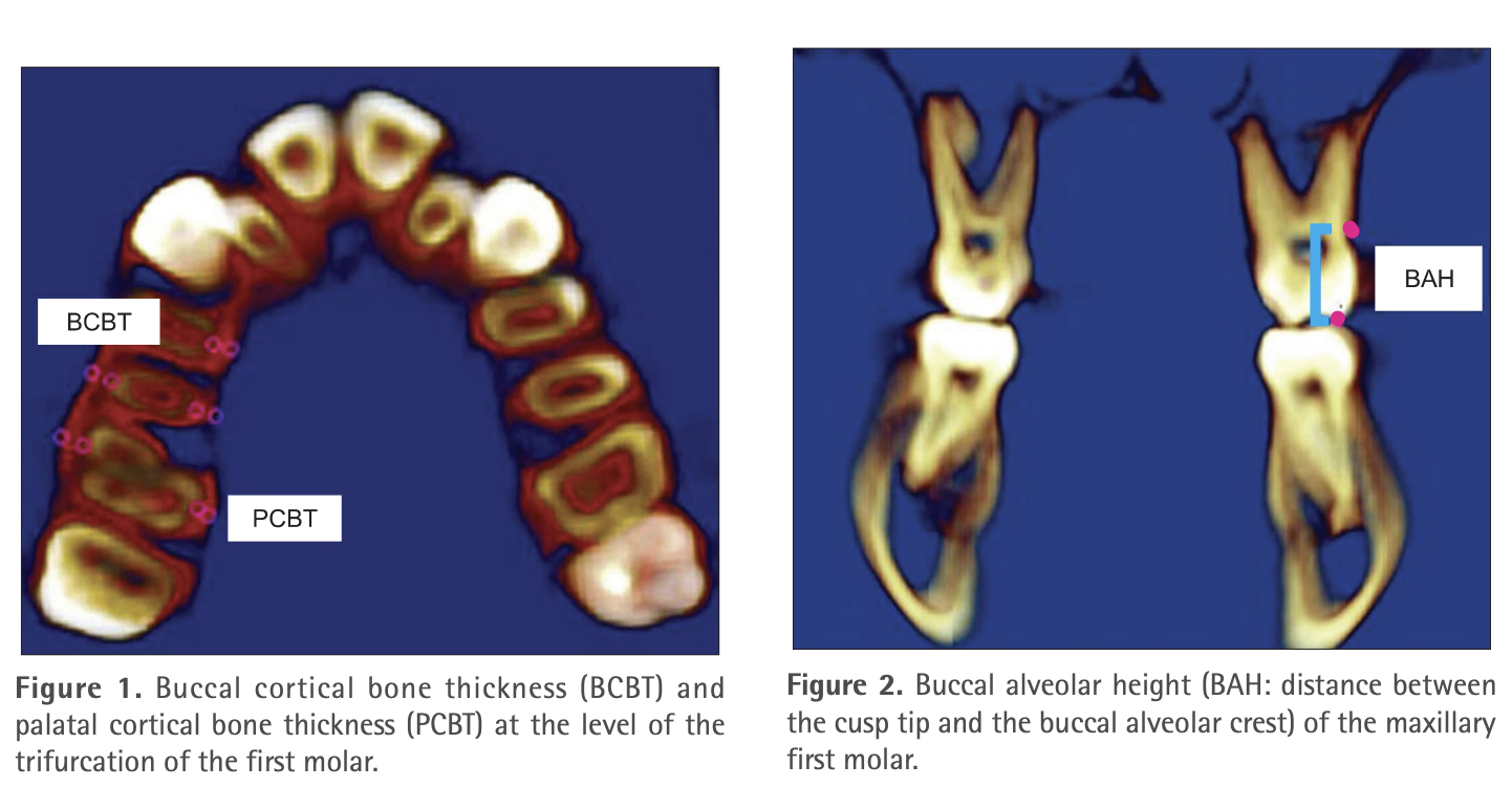Evaluation of alveolar bone loss following rapid maxillary expansion ...