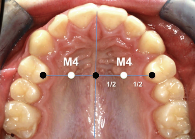 Paramedian vertical palatal bone height for mini-implant insertion: a ...