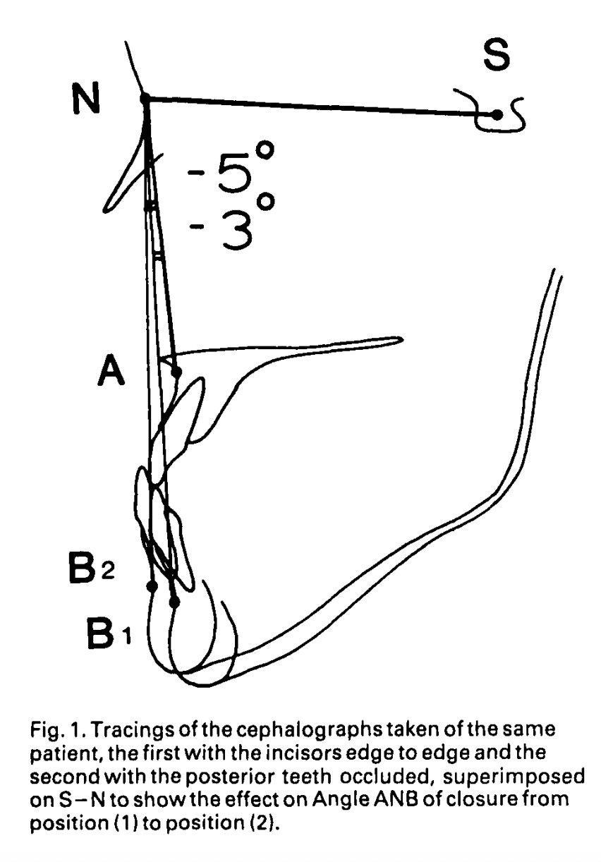 A Study of the Mandibular Closure Path in Angle Class III Relationship ...