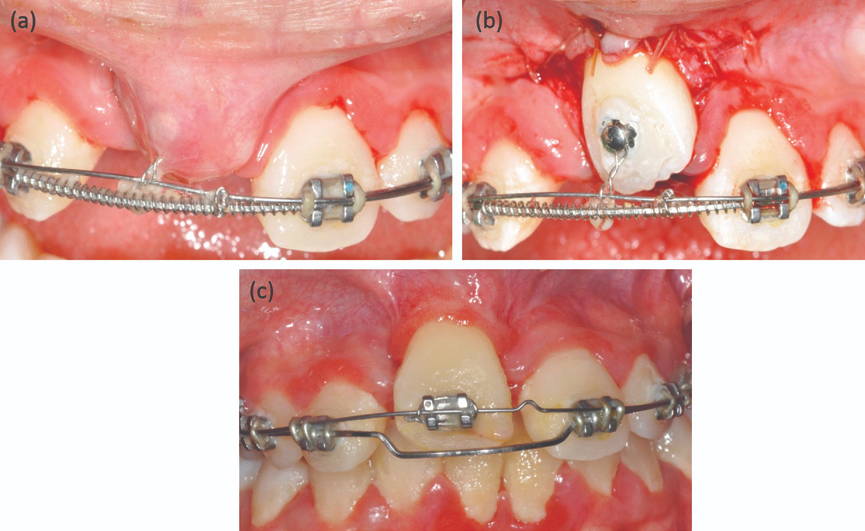 Soft-tissue management of labially positioned unerupted teeth – Dentowesome